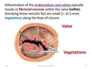 Rheumatic Fever Valve