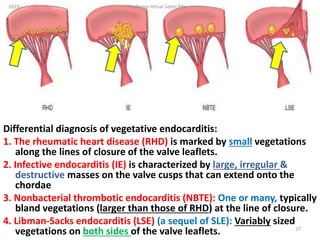Vegetations Of Infective Endocarditis