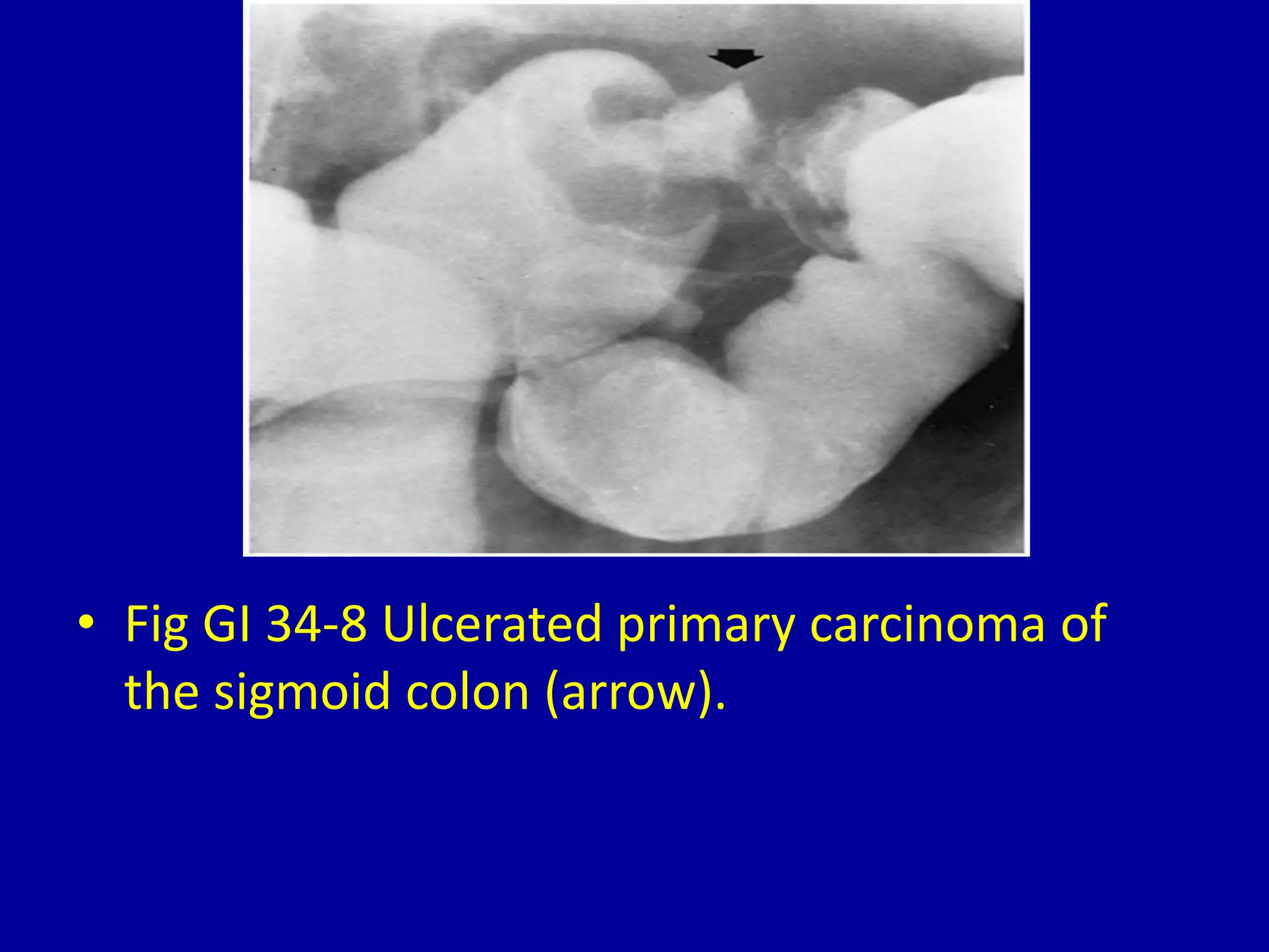 34 ulcerative lesions of the colon | PPTX