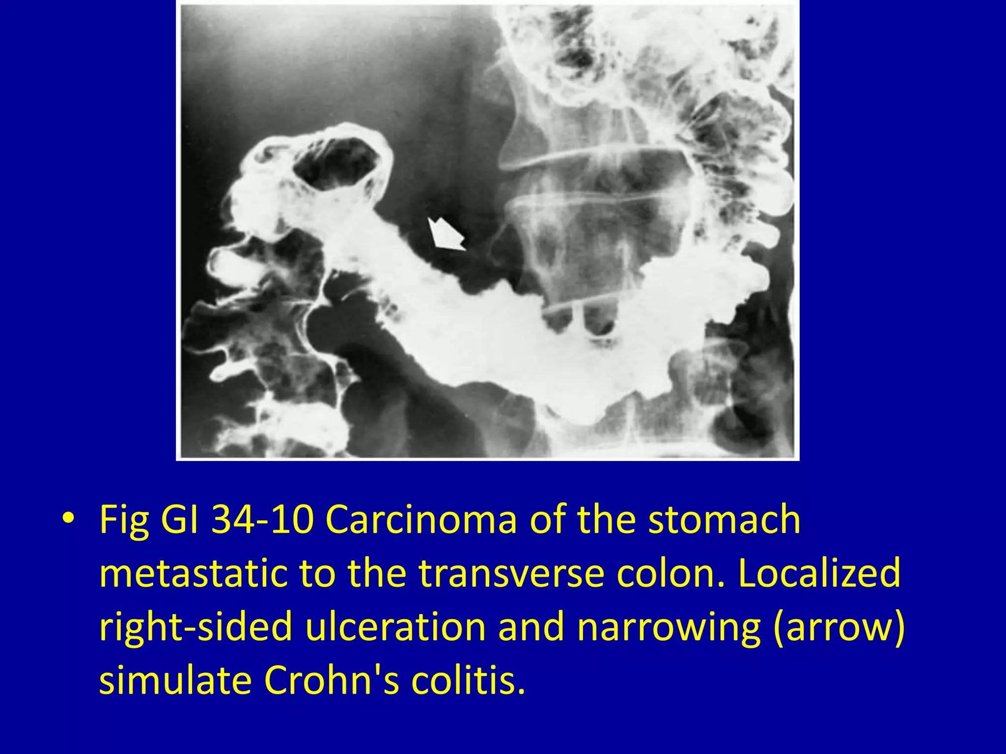 34 ulcerative lesions of the colon | PPTX