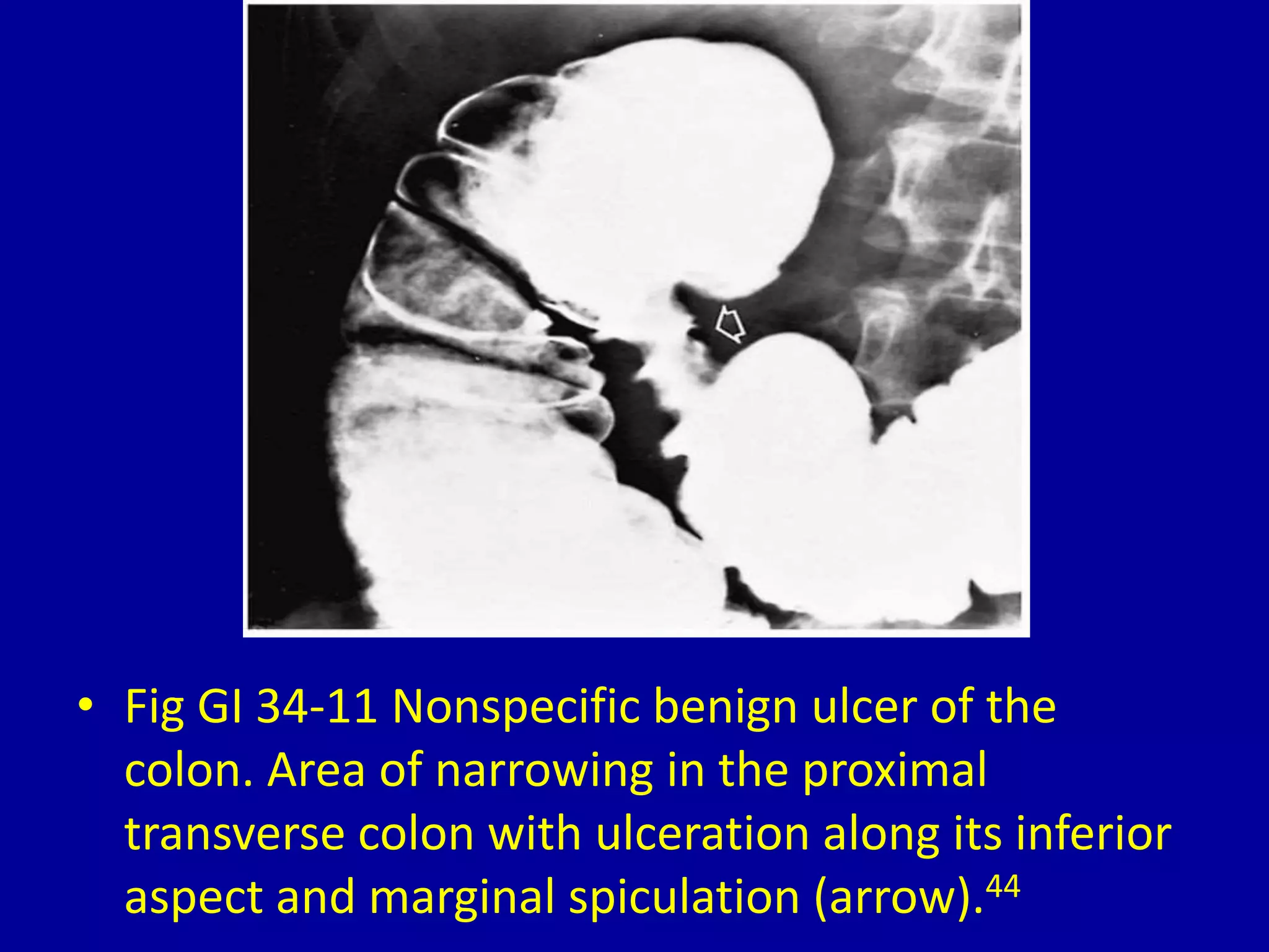 34 ulcerative lesions of the colon | PPTX