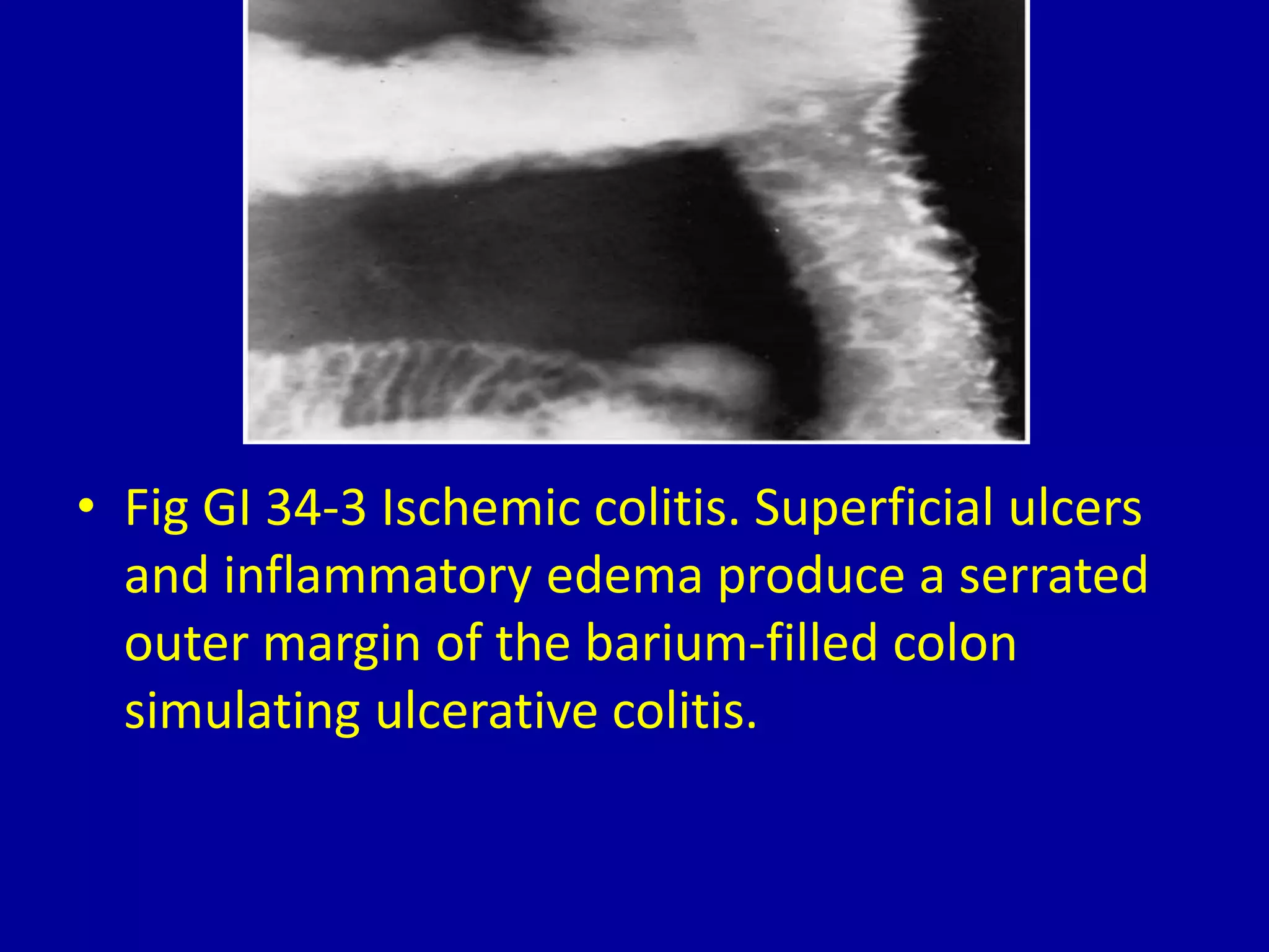 34 ulcerative lesions of the colon | PPTX