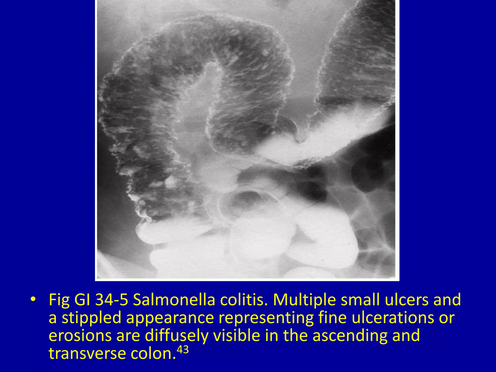 34 ulcerative lesions of the colon | PPTX