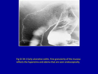 34 ulcerative lesions of the colon | PPTX
