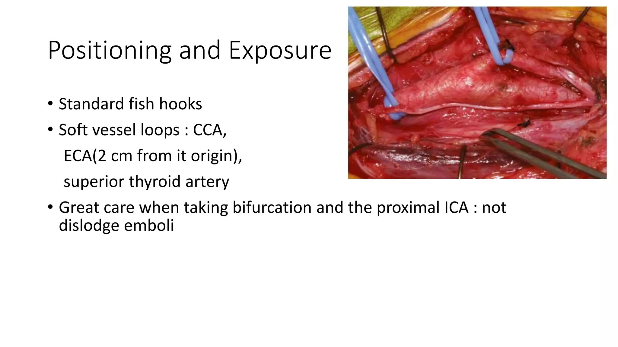 350 Carotid endarterectomy | PPTX