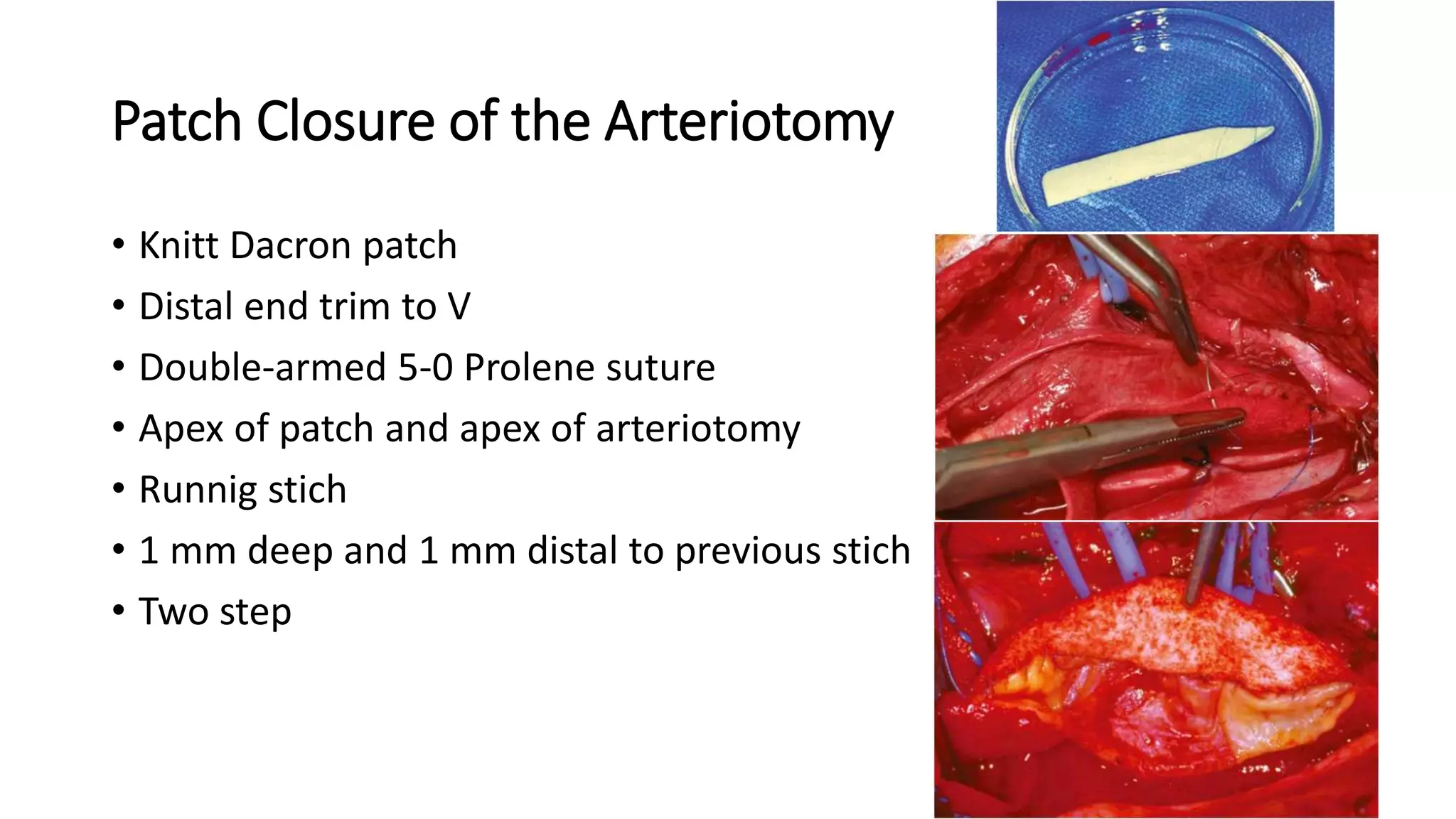 350 Carotid endarterectomy | PPTX