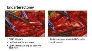 350 Carotid endarterectomy | PPT