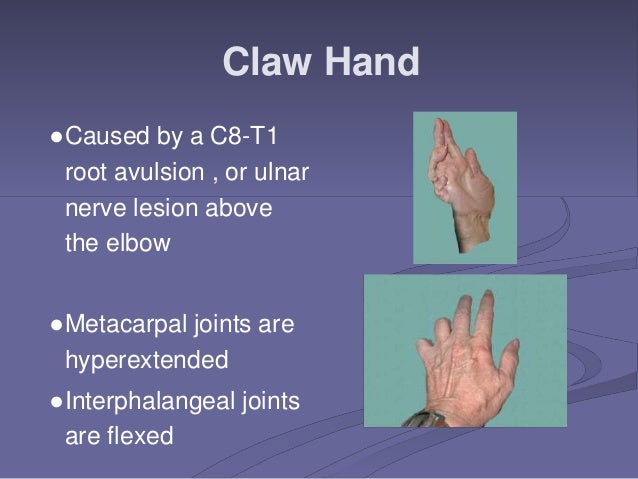 Cervical Radiculopathy Power Point.ppt