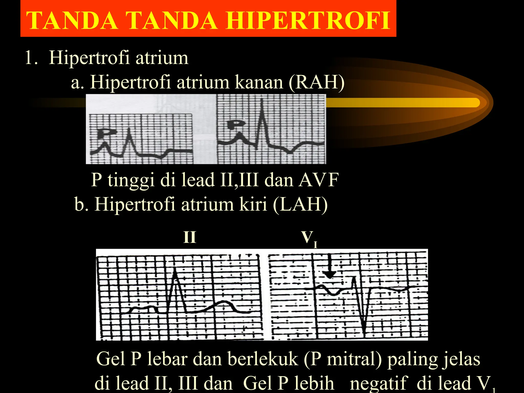 354492781-EKG-ARITMIA-ppt ARITMIA JANTUNG | PPT