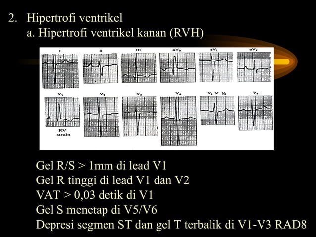 354492781-EKG-ARITMIA-ppt ARITMIA JANTUNG | PPT