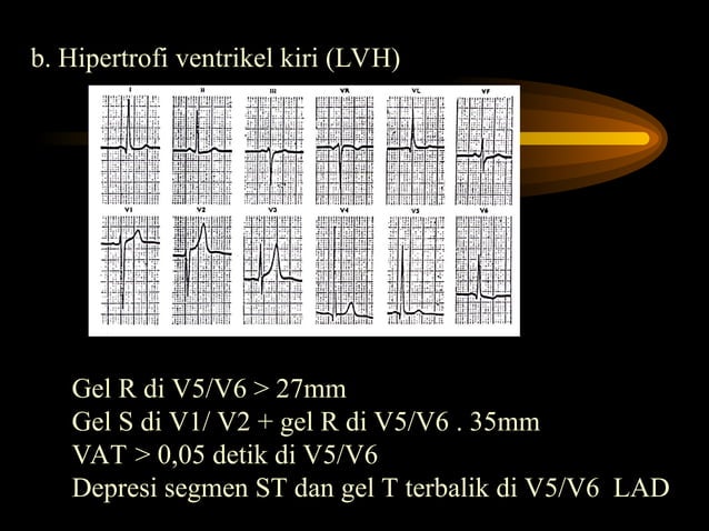 354492781-EKG-ARITMIA-ppt ARITMIA JANTUNG | PPT