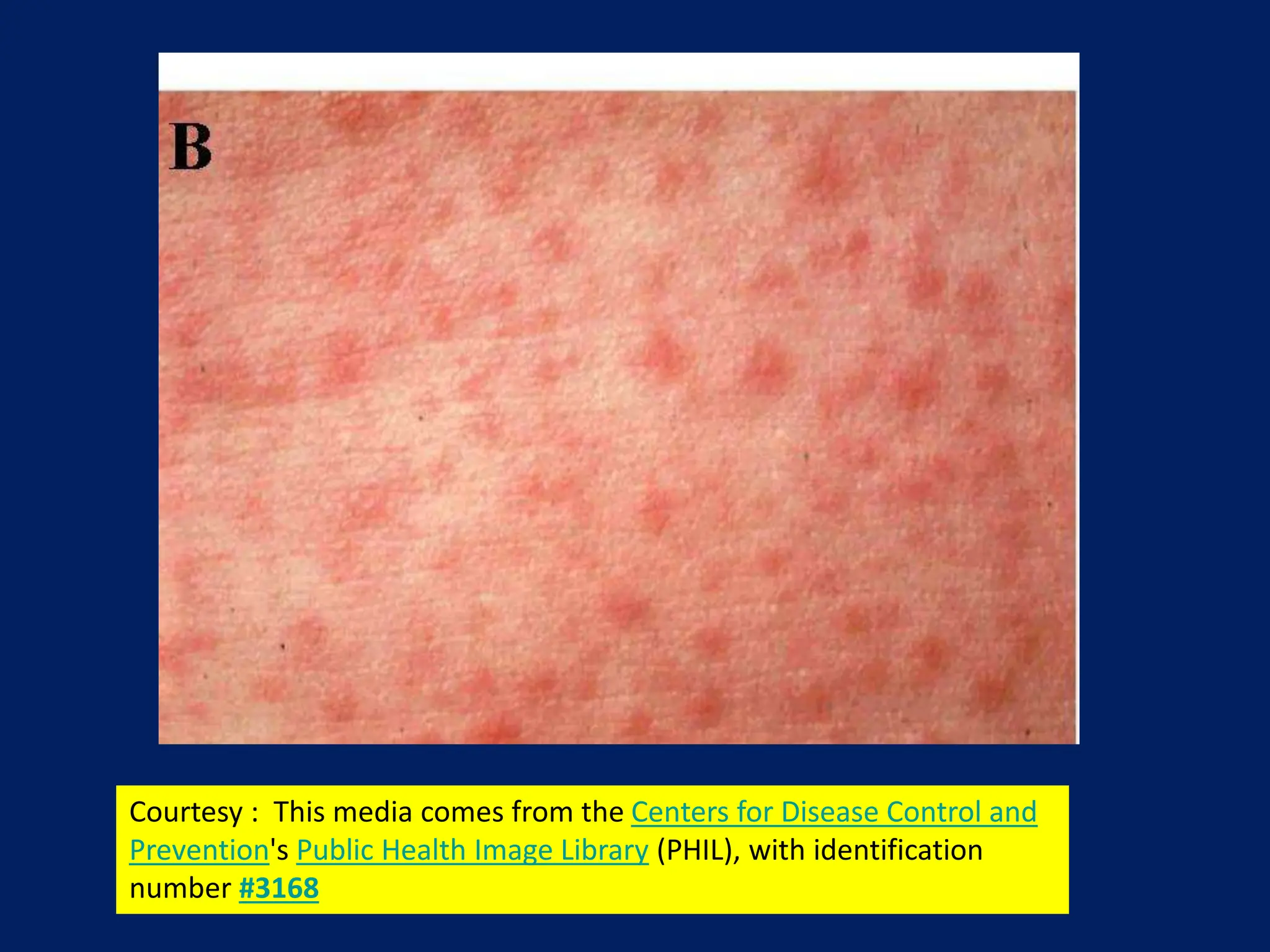 German-Measles 355588092-German-Measles.ppt