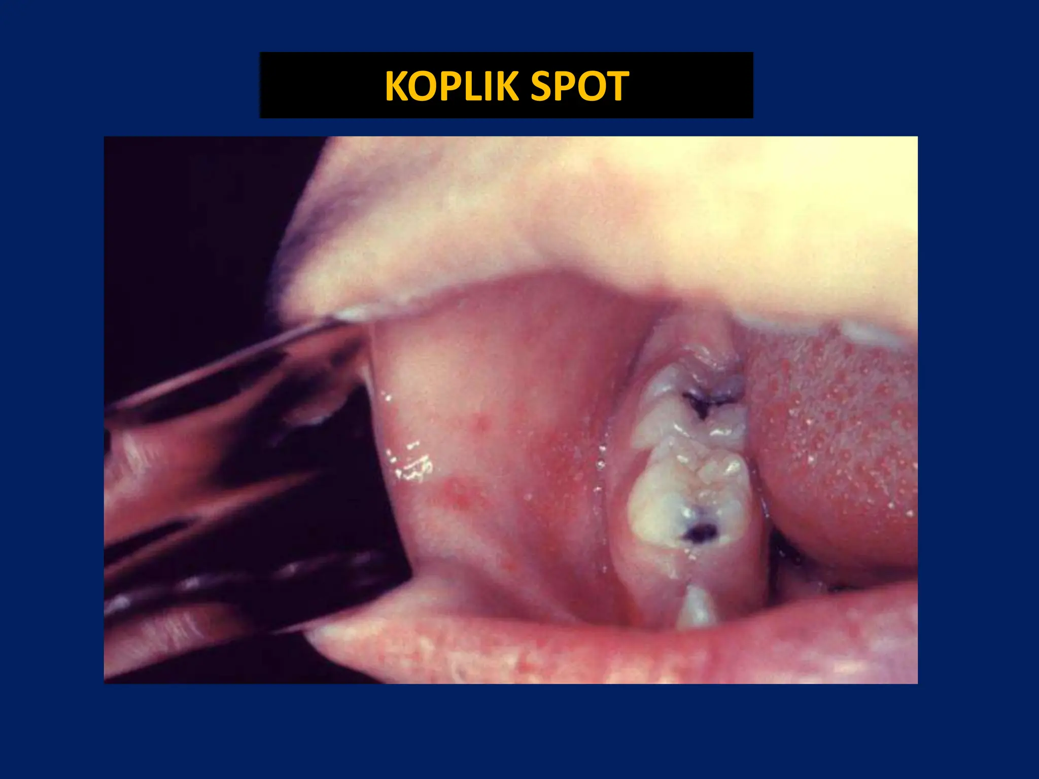 German-Measles 355588092-German-Measles.ppt