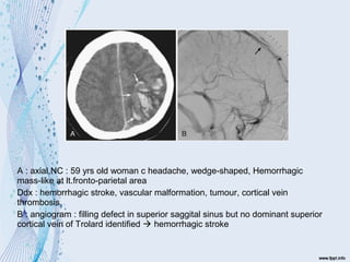 357 Cerebral venous and sinus thrombosis | PPT