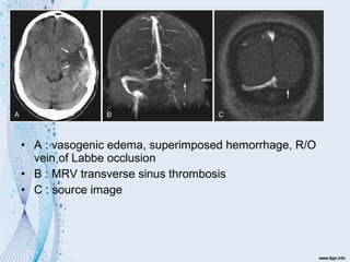 357 Cerebral venous and sinus thrombosis | PPT