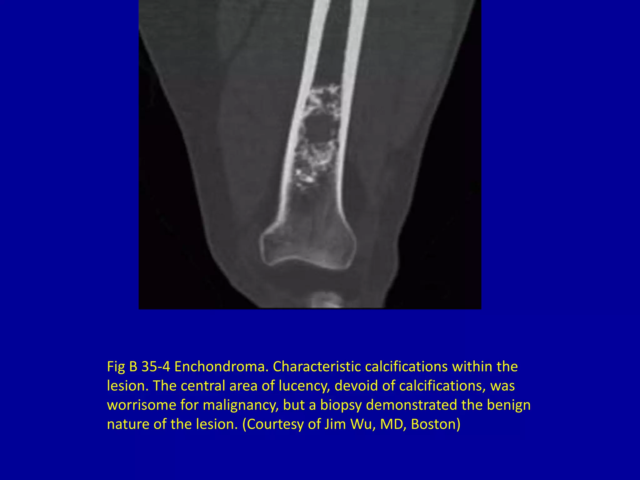 35 benign bone tumors and tumor like processes on | PPTX