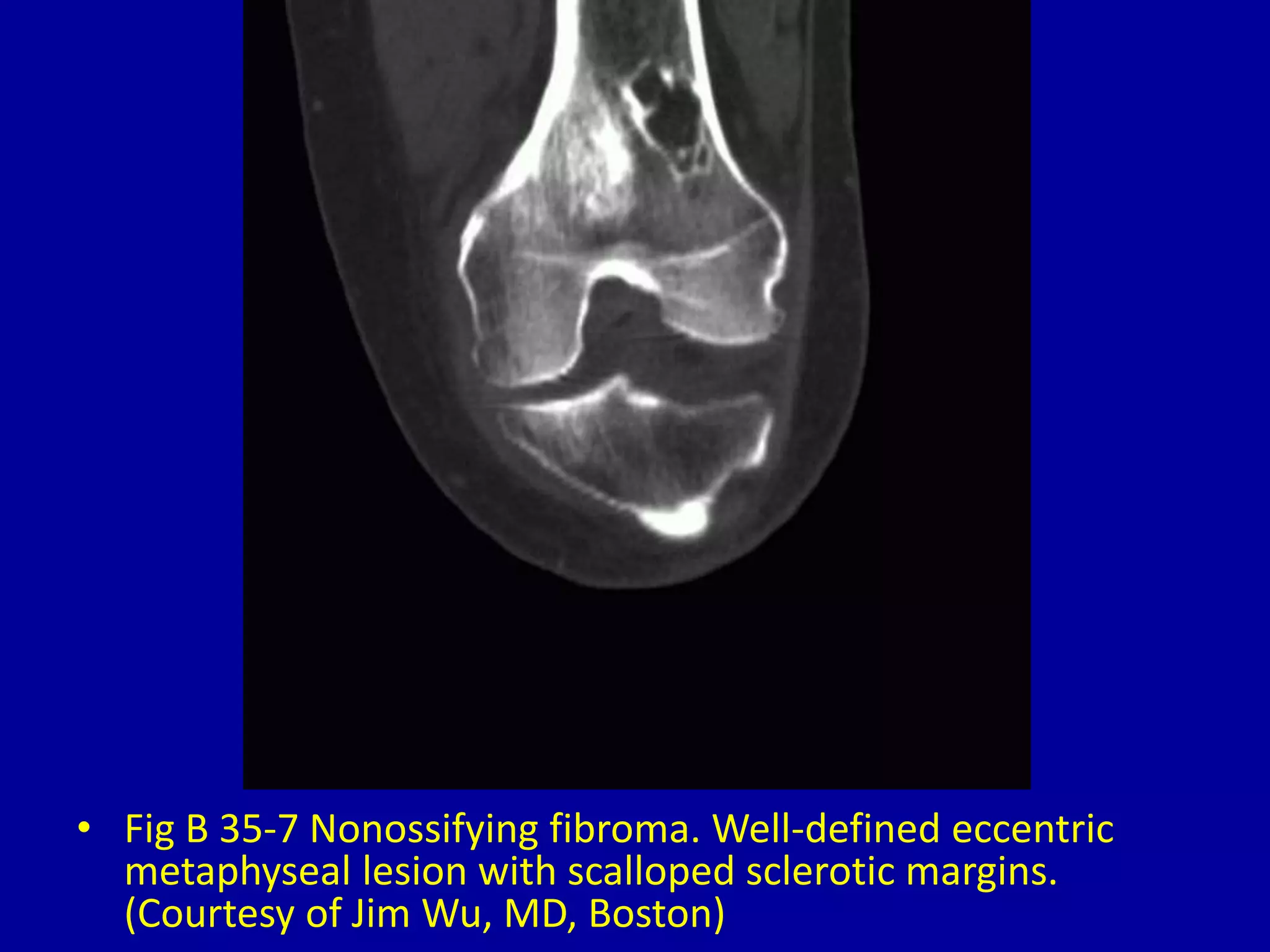 35 benign bone tumors and tumor like processes on | PPTX