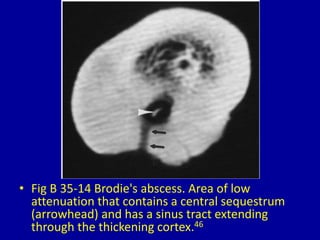 35 benign bone tumors and tumor like processes on | PPTX | Death ...