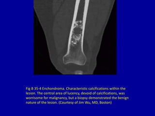 35 benign bone tumors and tumor like processes on | PPTX