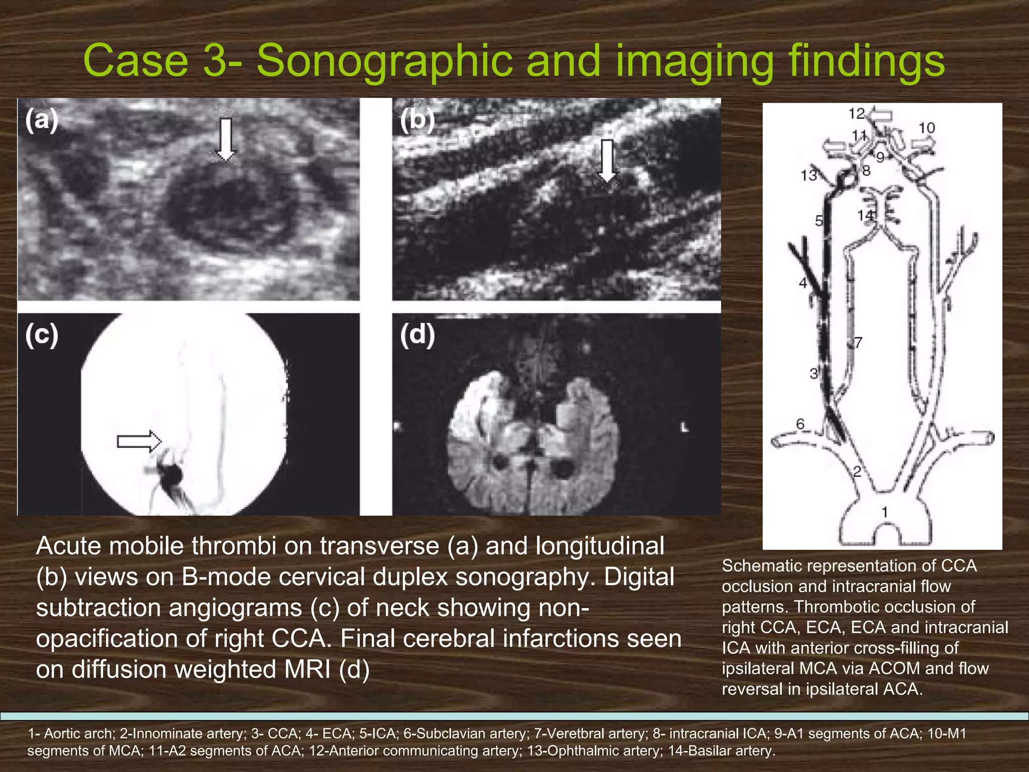 Thrombotic Occlusion Of The Common Carotid Artery | PPT