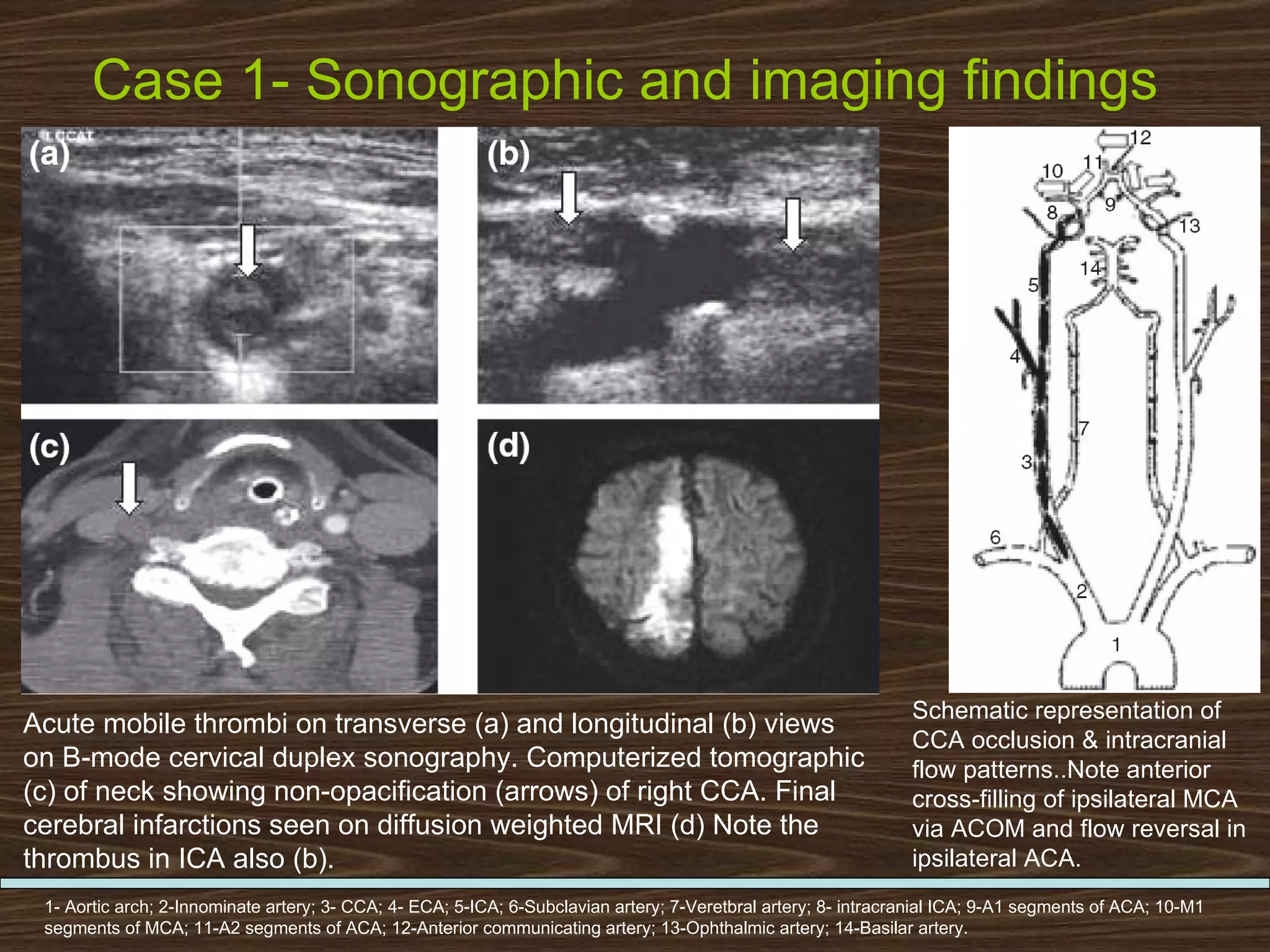 Thrombotic Occlusion Of The Common Carotid Artery | PPT