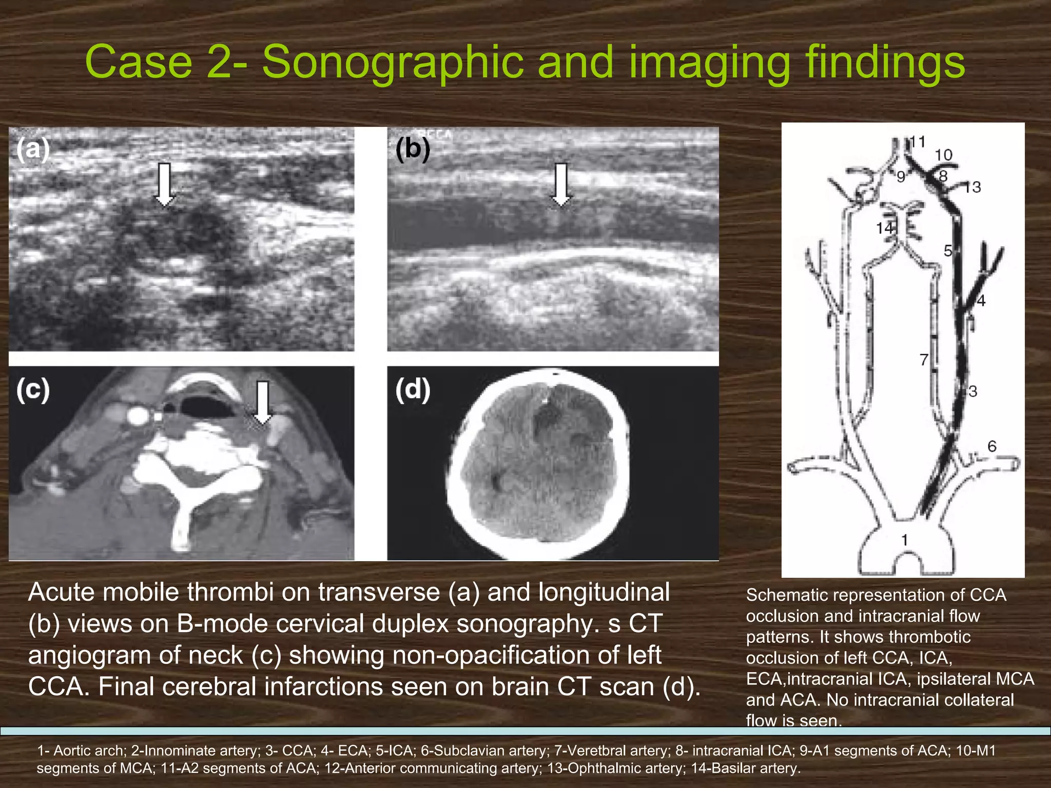 Thrombotic Occlusion Of The Common Carotid Artery | PPT