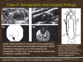 Thrombotic Occlusion Of The Common Carotid Artery | PPT
