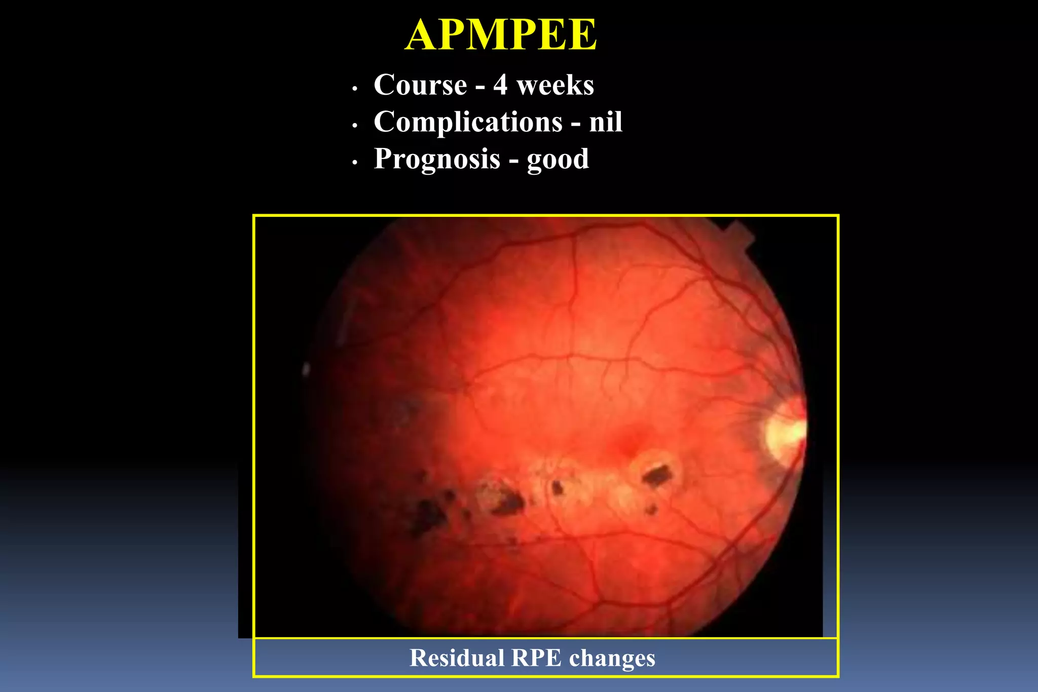 WHITE DOT SYNDROMES OF THE RETINAL INFLAMATION | PPT | Eye and Vision ...