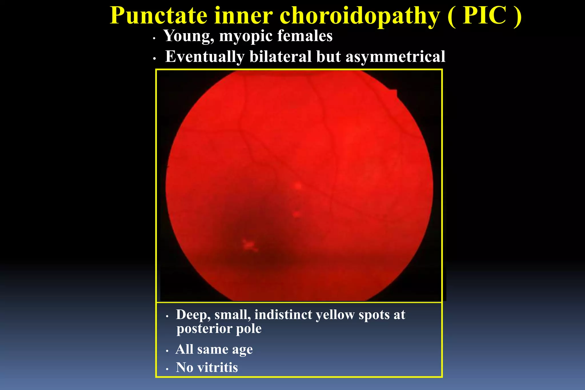 WHITE DOT SYNDROMES OF THE RETINAL INFLAMATION | PPT | Eye and Vision ...