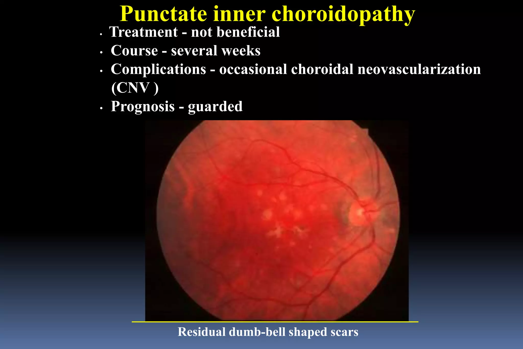 WHITE DOT SYNDROMES OF THE RETINAL INFLAMATION | PPT | Eye and Vision ...