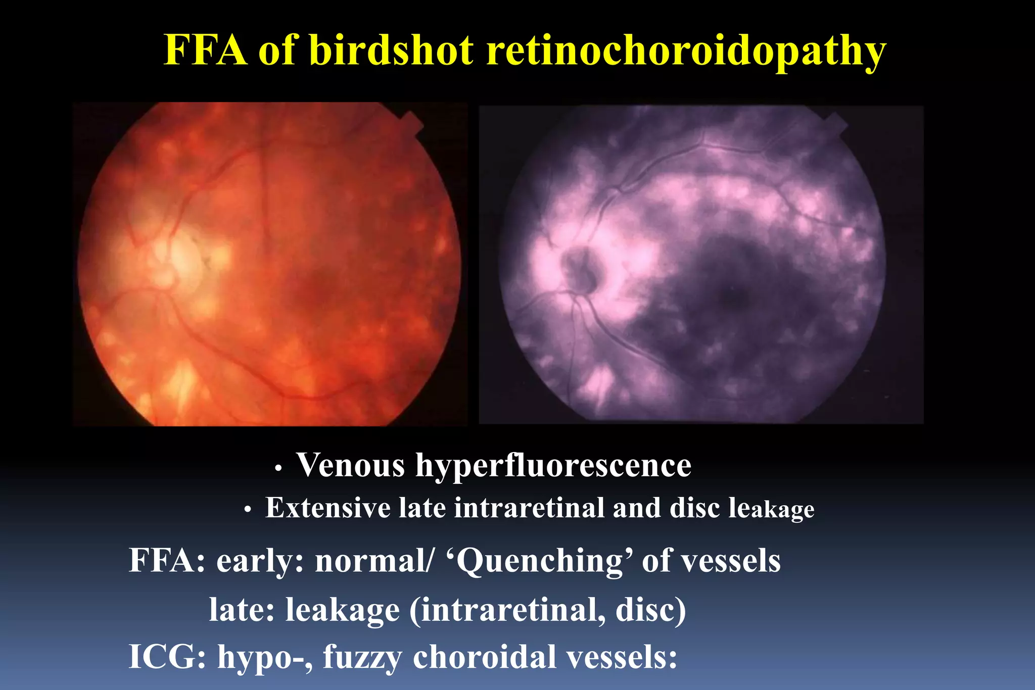 WHITE DOT SYNDROMES OF THE RETINAL INFLAMATION | PPT | Eye and Vision ...