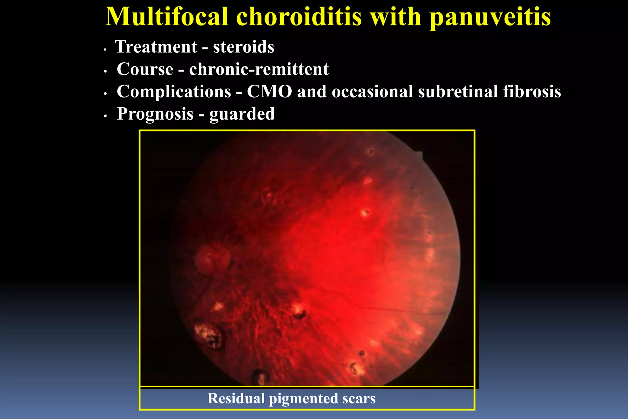 WHITE DOT SYNDROMES OF THE RETINAL INFLAMATION | PPT | Eye and Vision ...