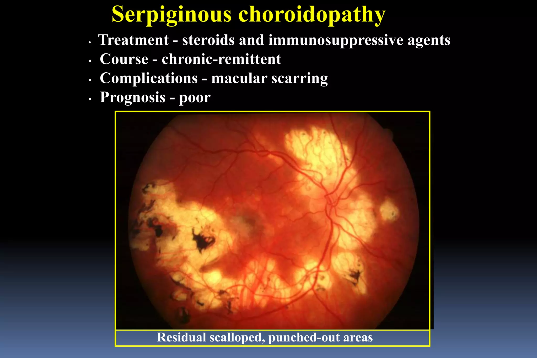 WHITE DOT SYNDROMES OF THE RETINAL INFLAMATION | PPT | Eye and Vision ...