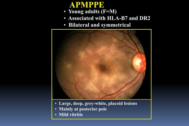WHITE DOT SYNDROMES OF THE RETINAL INFLAMATION | PPT | Eye and Vision ...