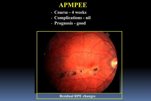 WHITE DOT SYNDROMES OF THE RETINAL INFLAMATION | PPT | Eye and Vision ...