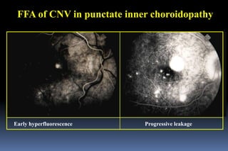 WHITE DOT SYNDROMES OF THE RETINAL INFLAMATION | PPT | Eye and Vision ...