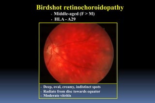 WHITE DOT SYNDROMES OF THE RETINAL INFLAMATION | PPT