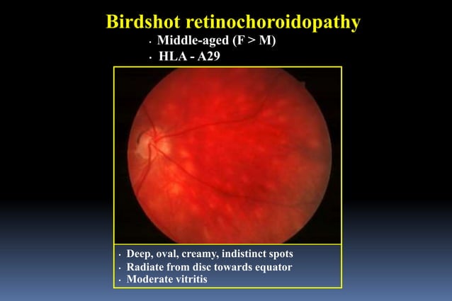 WHITE DOT SYNDROMES OF THE RETINAL INFLAMATION | PPT | Eye and Vision ...