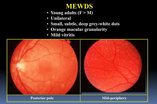 WHITE DOT SYNDROMES OF THE RETINAL INFLAMATION | PPT | Eye and Vision ...