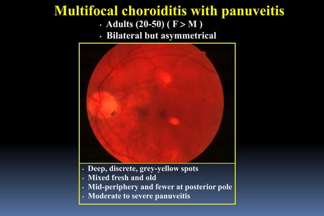 WHITE DOT SYNDROMES OF THE RETINAL INFLAMATION | PPT | Eye and Vision ...