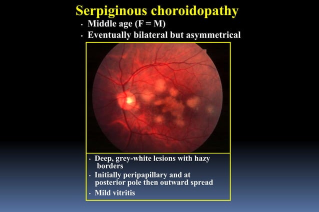 WHITE DOT SYNDROMES OF THE RETINAL INFLAMATION | PPT | Eye and Vision ...