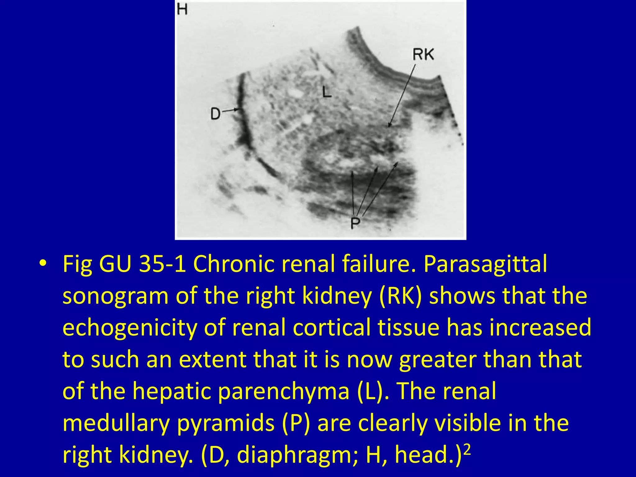 35 increased renal cortical echogenicity with preservation of | PPTX