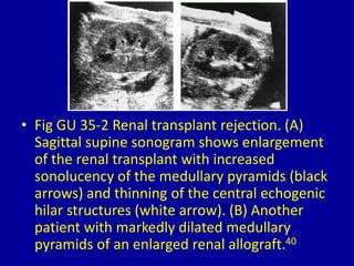 35 increased renal cortical echogenicity with preservation of | PPTX