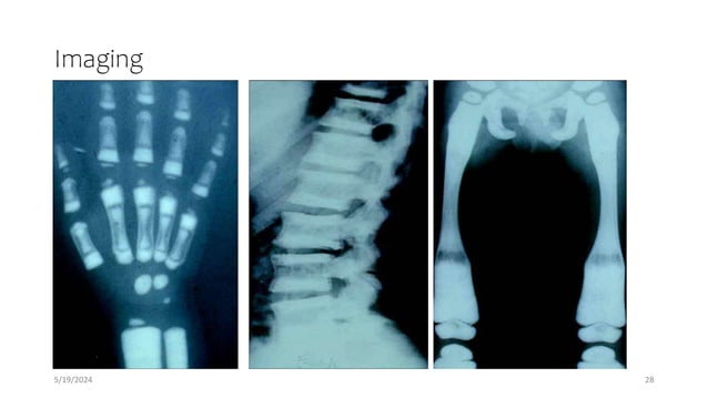 Inheritance Pattern of Orthopedics Syndrome.pptx