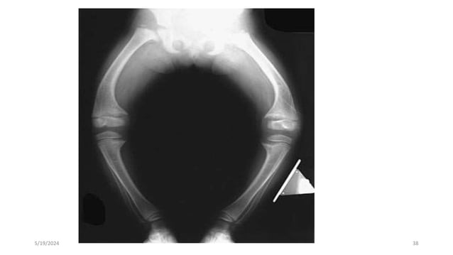 Inheritance Pattern of Orthopedics Syndrome.pptx