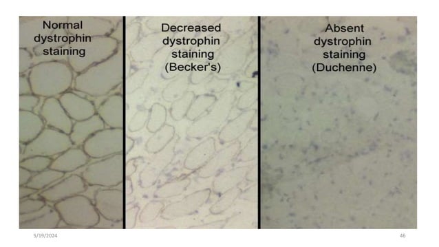Inheritance Pattern of Orthopedics Syndrome.pptx
