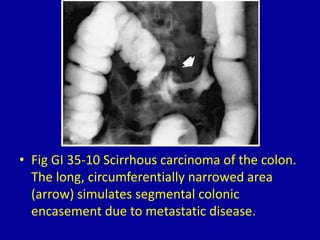 35 narrowing of the colon | PPTX