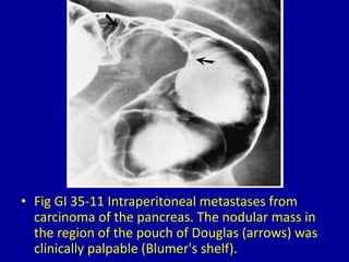 35 narrowing of the colon | PPTX