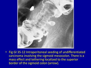 35 narrowing of the colon | PPTX