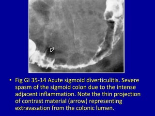 35 narrowing of the colon | PPTX